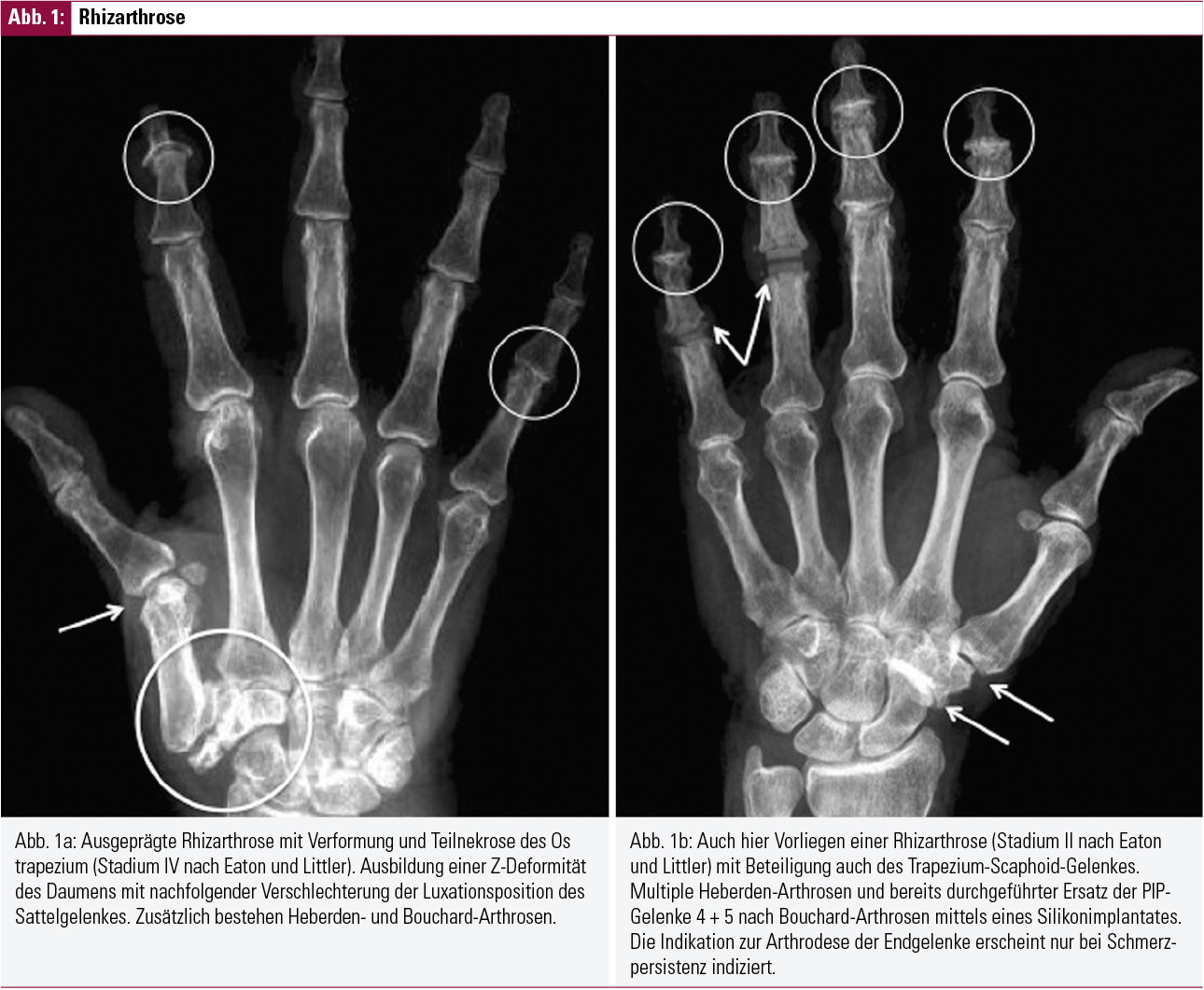 Die Behandlung der Fingerpolyarthrosen | Fakten der Rheumatologie ...