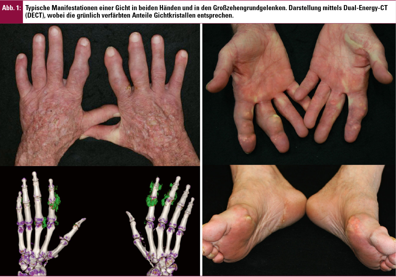 Neue Therapiekonzepte bei Gicht | Fakten der Rheumatologie | MedMedia