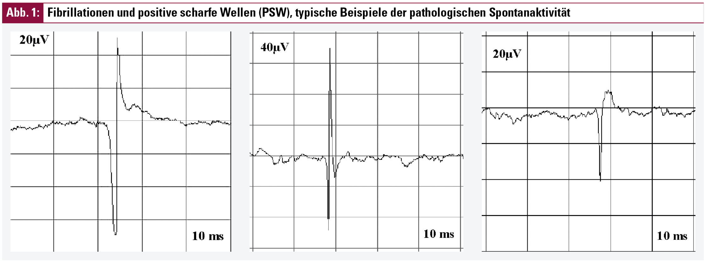 Wertigkeit der Elektromyografie bei Diagnose inflammatorischer ...