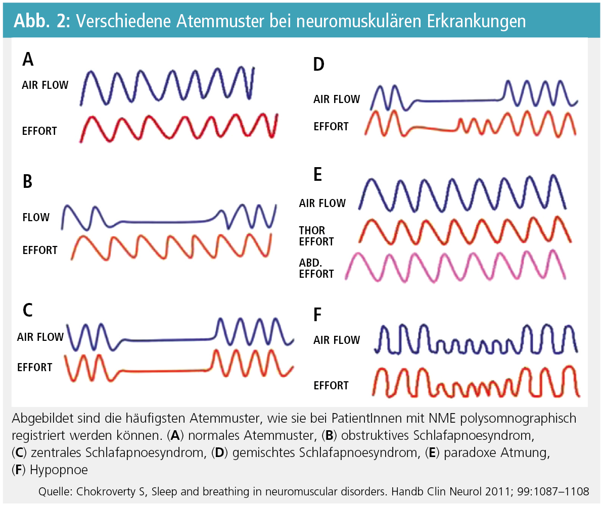 Schlafstörungen bei PatientInnen mit neuromuskulären Erkrankungen ...
