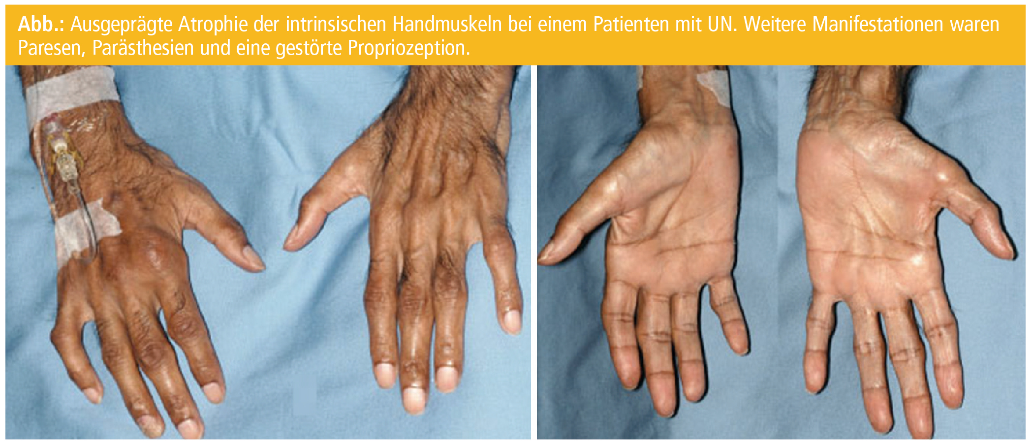 Die urämische Neuropathie | Neurologisch | MedMedia