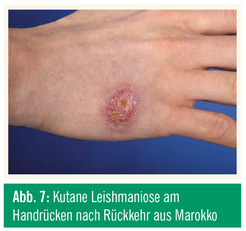 Fallbericht: Photodynamische Therapie bei kutaner Leishmaniose ...